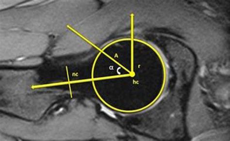 Magnetic Resonance Image Depicting The Alpha Angle Measurement Point A