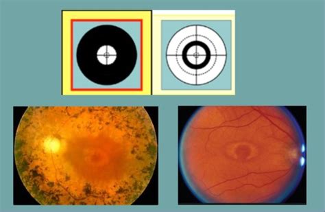 32 Primary Visual Pathway Cont Visual Field Interpretation Flashcards