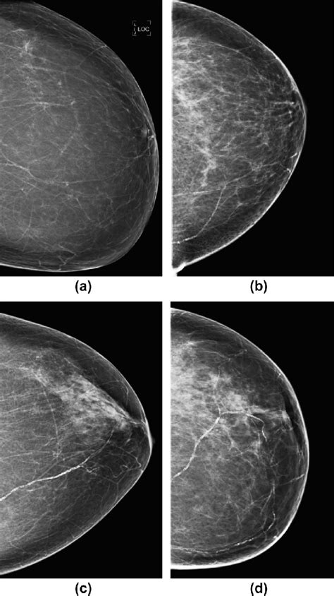 Semi Quantitative Likert Scale Of Breast Arterial Calcification A