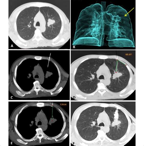 A Axial Ct Images Showing Left Upper Lobe Mass B 3d Vr Of Airways Download Scientific Diagram
