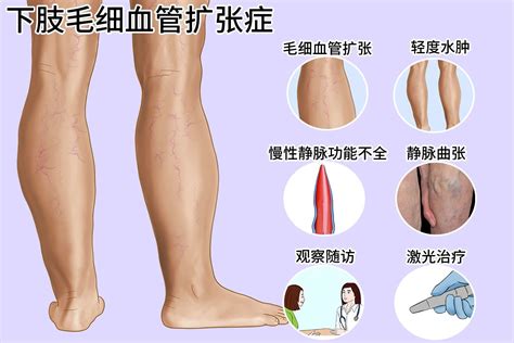 腿部毛细血管扩张症图片 百度健康·医学科普 腿部毛细血管扩张症图片 百度健康·医学科普