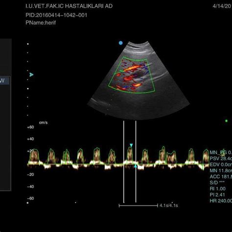 Color Doppler Visualization Of Hepatic Vasculature And Pulsed Doppler
