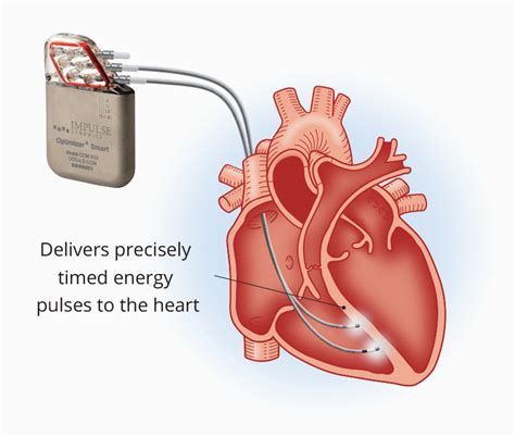 Cardiac Contractility Modulation Ccm Trinity Health Michigan