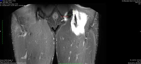 Complete Tear Of Proximal Hamstring Tendon Dr Zoran Tocilj