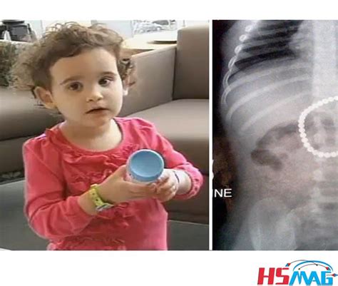 A Girl Swallowed Toy Magnet By Mistake And The Doctor Took It Out Smoothly Magnets By Hsmag