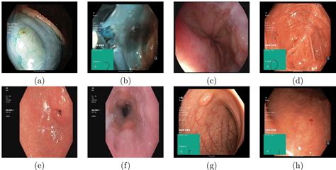 논문 리뷰 Enhanced Multi Class Classification Of Gastrointestinal