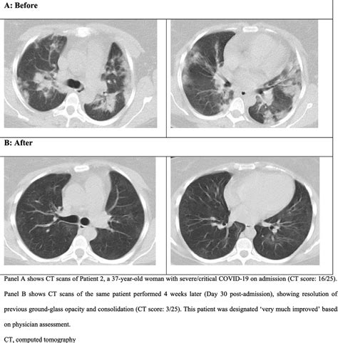Ct Scan Without Contrast At Evelyn Lawson Blog