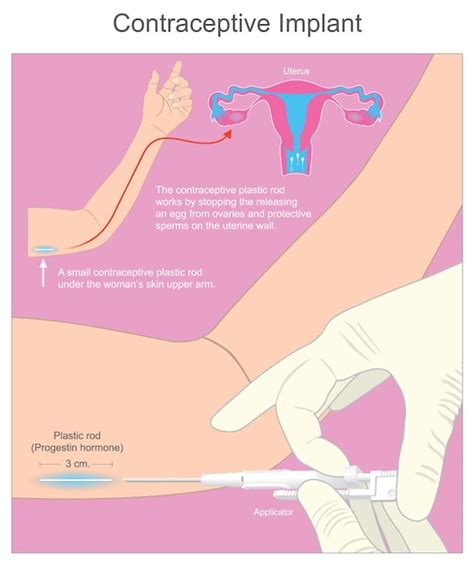 Implante Anticonceptivo Una Pequeña Varilla Plástica Anticonceptiva