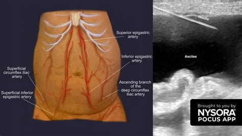 Paracentesis Paracentesis Periprocedural Care Patient Education And