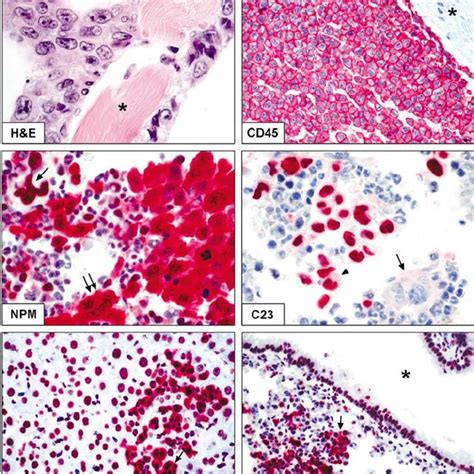 The Ociaml3 Cell Line Carries Mutation A At Exon 12 Of The Npm Gene