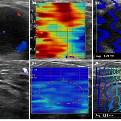 Principle Of 2 D Shear Wave Elastography 2dswe For Case 1 And 2 Download Scientific