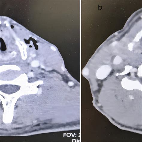 A Remodeling Of Piriform Fossa And Repair Defect With Contralateral Download Scientific Diagram