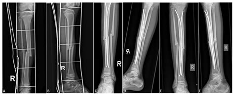 Distal Tibia Fracture Classification