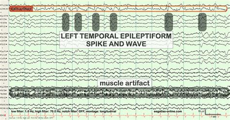 Eeg Basics Waveform Morphology