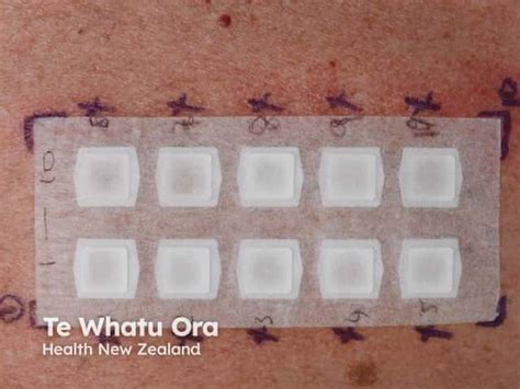 Atopy Patch Test