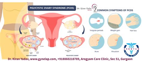 Pcod Causes Symptoms And Treatment Comprehensive Guide Gynelap
