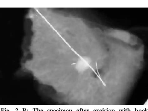 Figure 2 From Hook Wire Localization Procedure In Biopsy And Diagnosis Of Early Breast Cancers