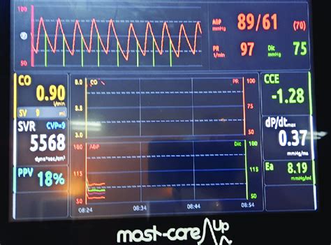 continuous cardiac output monitoring by mostcare up pram monitor