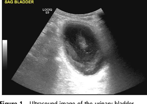 Abscess Of Bladder Semantic Scholar
