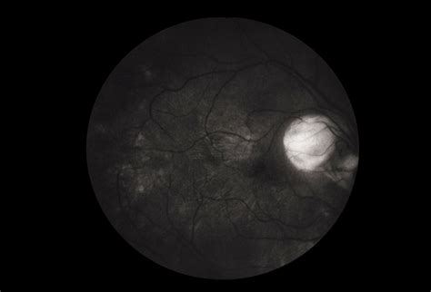 Cysticercus Toxocara Retina Image Bank