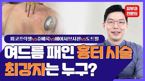 여드름흉터 시술 베스트는 피코 프락셀vs쥬베룩vs에어서브시전vs도트필 Youtube