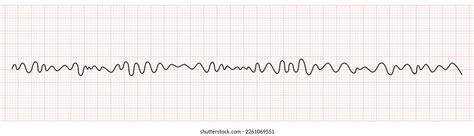 Ventricular Fibrillation Ecg