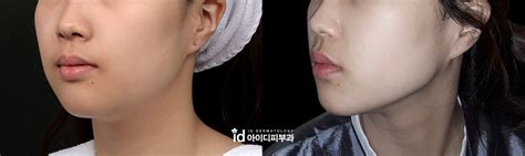 튠페이스 리프팅 아이디 피부과 디에이징 센터ㅣ강남 신사역 레이저 효과 가격 주름 고주파 초음파 시술 콜라겐 탄력 튠라이너 튠쎄라 튠페이스 아이디병원 피부과