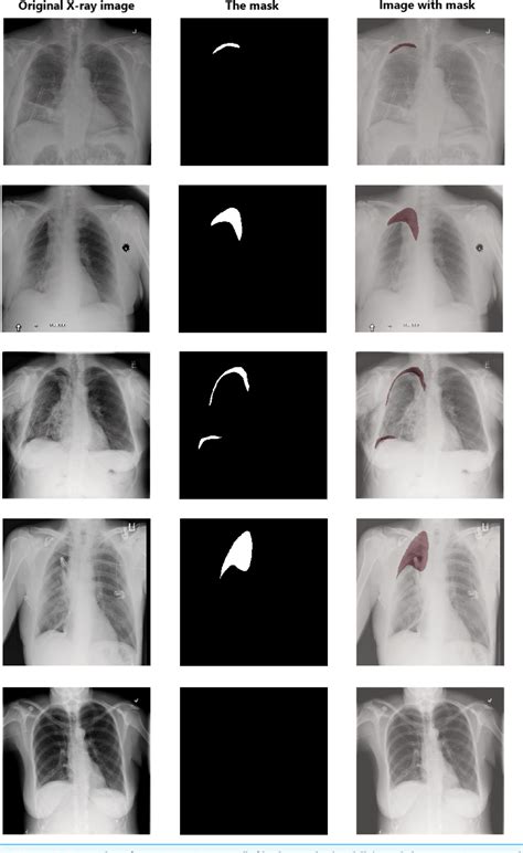 Table 1 From Chest X Ray Pneumothorax Segmentation Using U Net With Efficientnet And Resnet