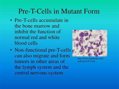 Ppt Notch1 And Pre T Cell Acute Lymphoblastic Leukemia T All By
