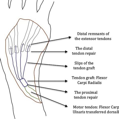 Exploration Showing The Extensor Tendon Defects In Zone 6 8 Note That Download Scientific