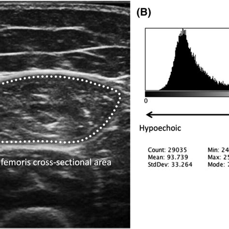 A Ultrasound Measurement Of The Rectus Femoris Muscle Cross‐sectional Download Scientific
