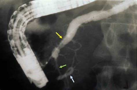 Pancreas Divisum Causes Symptoms Diagnosis Treatment And Prognosis