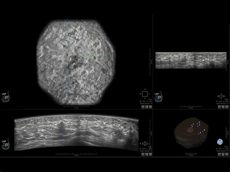 Breast Ultrasound Personalised Breast Care Logiq™