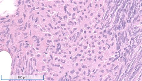 Week 766 Case 3 Johns Hopkins Surgical Pathology Unknown Conference