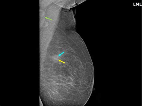 Atlas Of Breast Cancer Early Detection