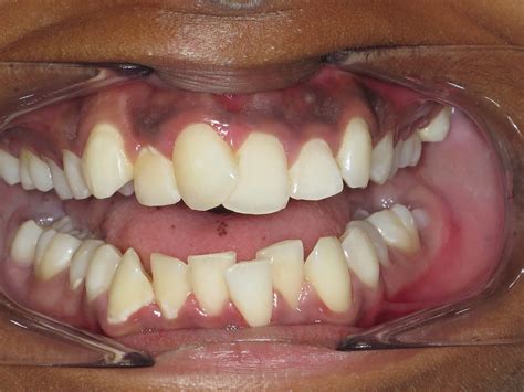 Crookedovercrowded Teeth Teeth In Line