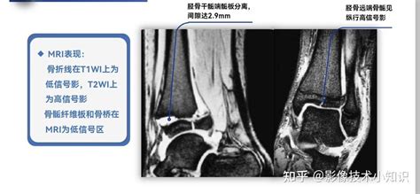 骨折影像诊断（2） 知乎
