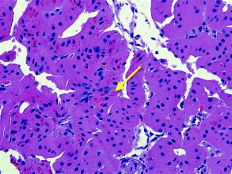 B Oncocytic Cells Forming Glandular Like Pattern With Minimal