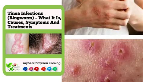 Tinea Infections Ringworm What It Is Causes Symptoms And Treatments