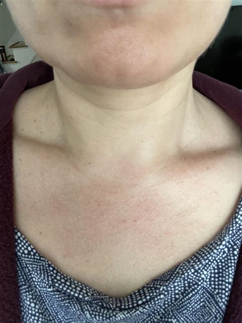 Chest Redness And Texture Acne R Acne