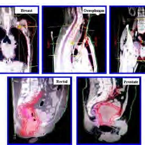 Dry Eye Severity Grading Scheme According To Dews 2007 Download Table