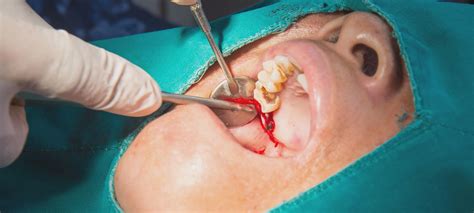 Wisdom Teeth Removal — What To Expect Discover Hidden
