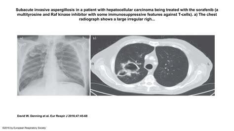 Presentation On Chronic Pulmonary Aspergillosis Pptx