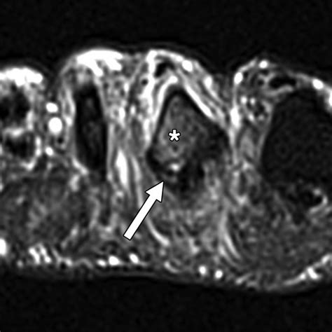 Second And Third Metatarsophalangeal Plantar Plate Tears Diagnostic