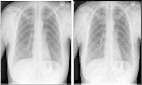 Figure 3 From Medical Image Quantization Using Biogeography Based Optimization Semantic Scholar