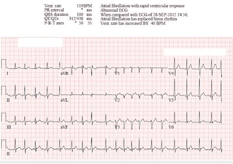 Initial ECG Obtained In The Emergency Department Demonstrating Atrial