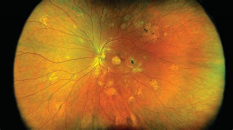Advanced Retinal Imaging The Key To Early Detection Of Eye Diseases EyeXam Optometry