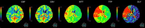 On Computed Tomography Perfusion Scan Delay Dly Time To Peak Ttp Download Scientific