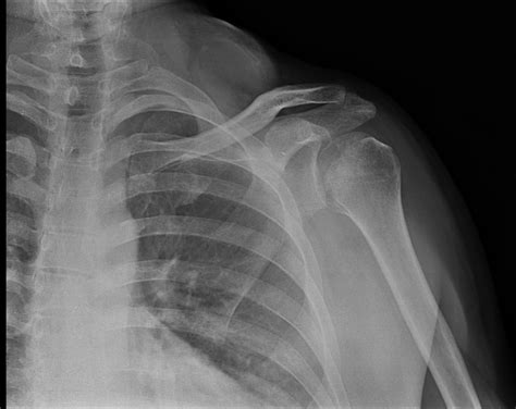 Ant Shoulder Dislocation X Ray At Robert Doss Blog