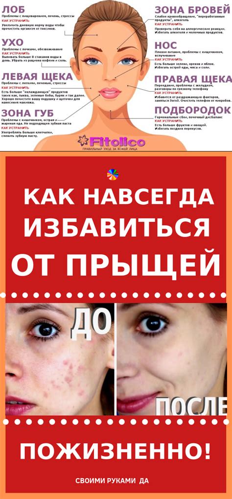 Как НАВСЕГДА избавиться от прыщей И называется этот чудо рецепт просто правильный режим